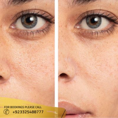 Large Pores Treatment In Islamabad ,Rawalpindi & Pakistan
