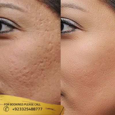 Large Pores Treatment In Islamabad ,Rawalpindi & Pakistan