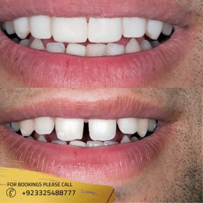Teeth Gap Filling Treatment in Islamabad-Rawalpindi & Pakistan